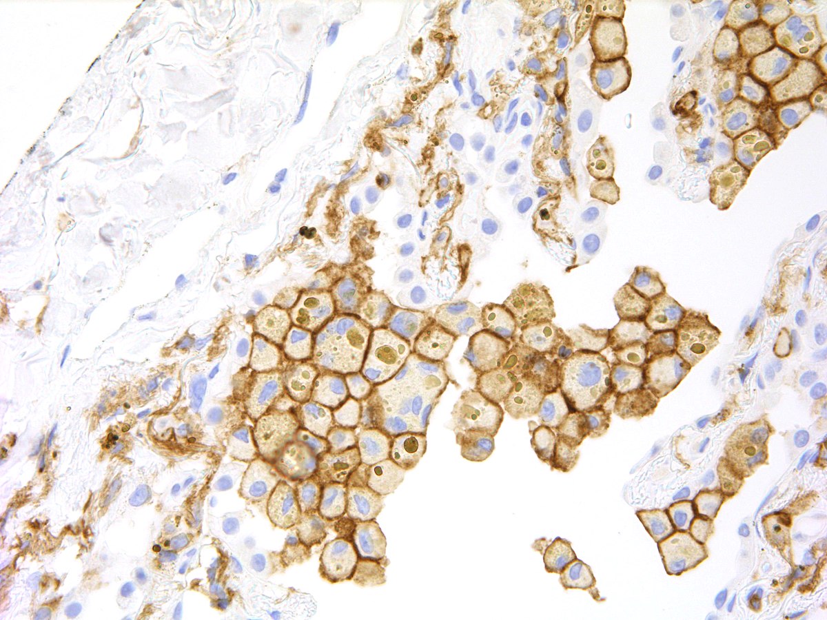 Melittin Induced G1 Cell Cycle Arrest and Apoptosis in Chago-K1 Human Bronchogenic Carcinoma ...